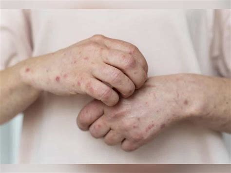 Pakistan Reports Fourth Case Of Mpox Latest In Pakistan Occupied Kashmir