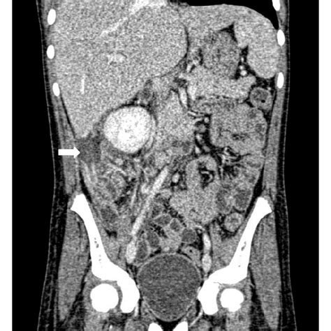 Contrast Enhanced Ct With Coronal A And Sagittal B Images Showing