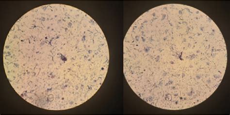Figure 1 From A Clinical Case Of Pulmonary Nocardiosis In An