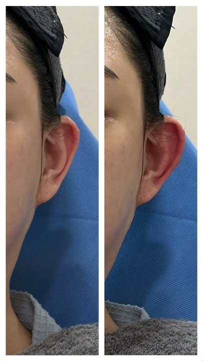 모델들께서 더 예뻐보이기 위해서 하시는 시술이 무엇일까요 Youtube