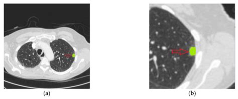 An Appraisal Of Lung Nodules Automatic Classification Algorithms For Ct