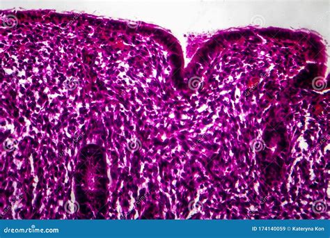 Endometrial Hyperplasia Light Micrograph Stock Image Image Of Illness Morphology 174140059