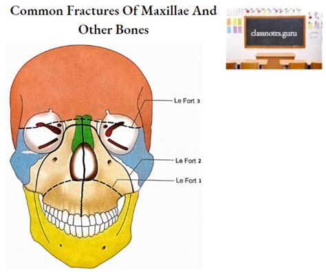 Maxilla Osteology Anatomy Notes Class Notes