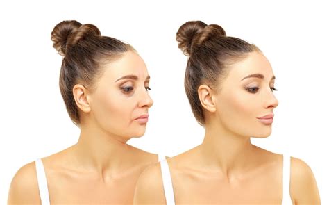 Dermal Filler Before And After Pics Do Fillers Really Work Guidance