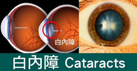 老人白内障眼睛图片 白内障和正常眼睛图片 眼睛图片 大山谷图库