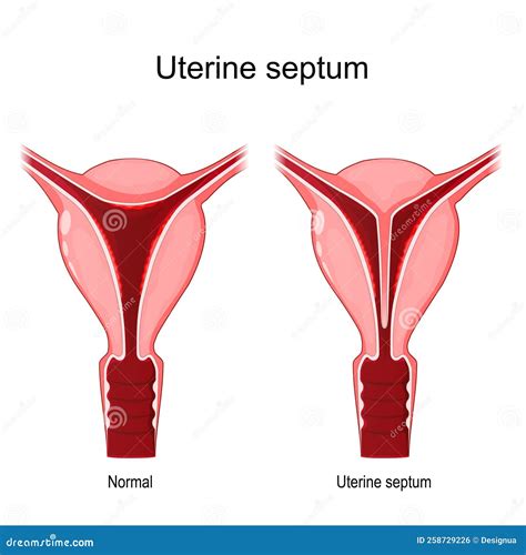 Uterine Septum Female Reproductive System Stock Vector Illustration