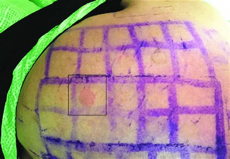 Patch Test Same Patient Shown In Figure 4 Showed Positive Reaction To Download Scientific