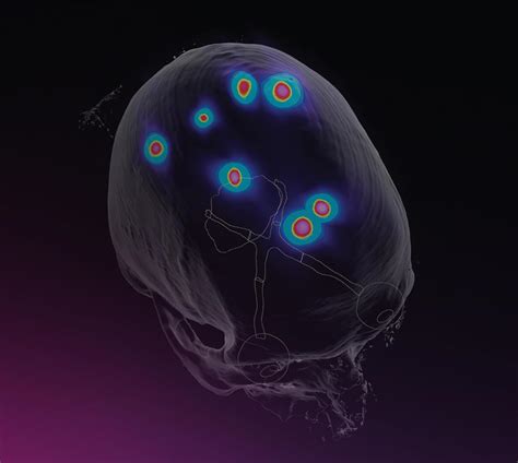 Brainlab Radiosurgery Planning Solutions Manage