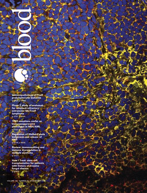 Prominent Pseudo Gaucher Cells In A Patient With β Thalassemia