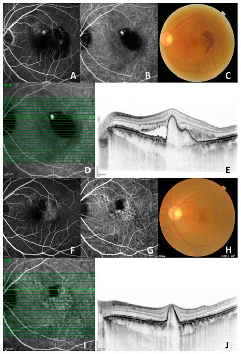 A Representative Case 76 Year Old Man Treated With A 3 Monthly Download Scientific Diagram