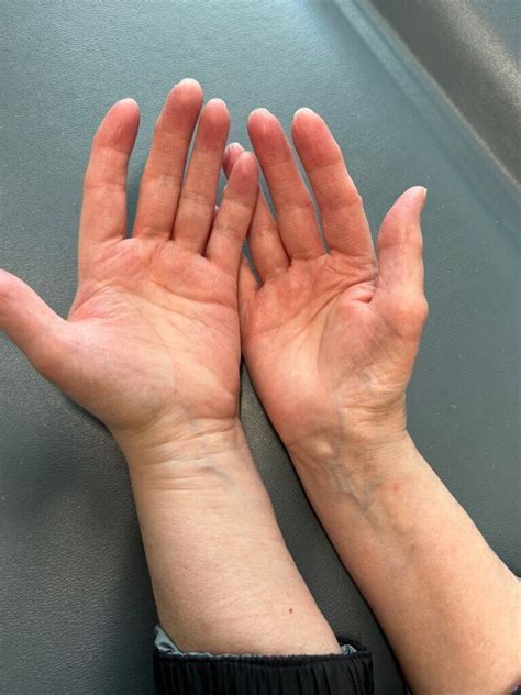 Orthodx Thenar Atrophy Clinical Advisor