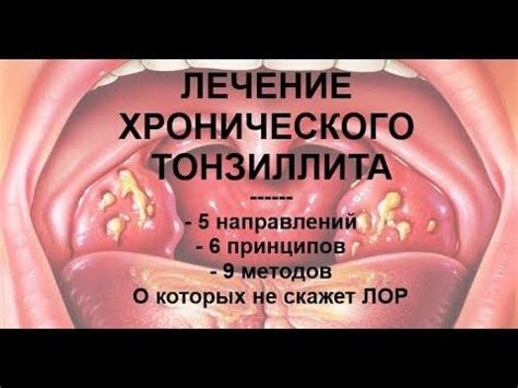 Хронический тонзиллит. История моего выздоровления после 20 лет мучений ...