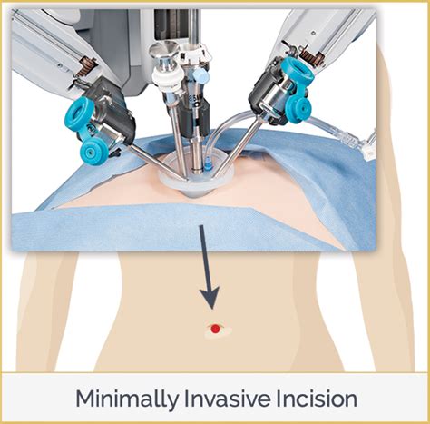 Minimally Invasive Laparoscopic Surgery By Starclinic On Deviantart