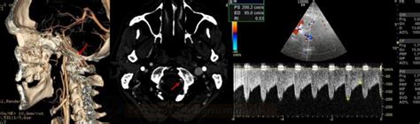 Anatomy Of Cerebral Arteries Stroke Manual
