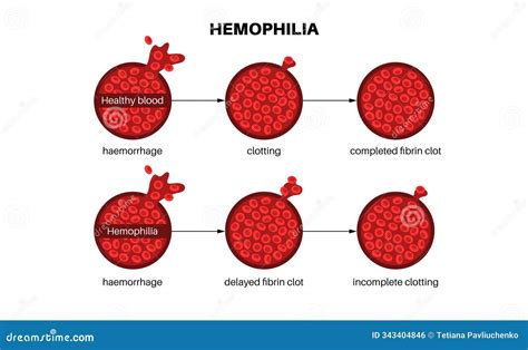 Hemophilia Day Infographic Flat Cartoon Hand Drawn Templates Background