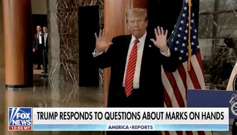 Not Syphilis Trump Finally Gives Ominous Answer Behind His Red Spotted