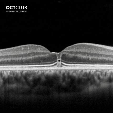 Laser Pointer Maculopathy At Katherine Thornton Blog