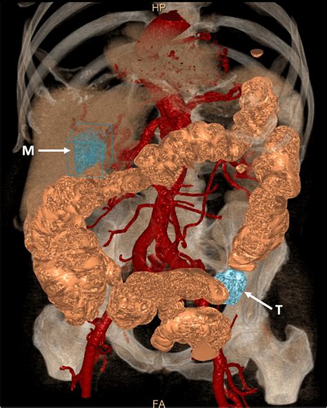 3d Modelling Intellispace Portal 100 Philips Healthcare Best The