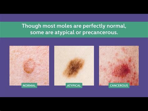 Cancerous Moles Vs Normal Moles