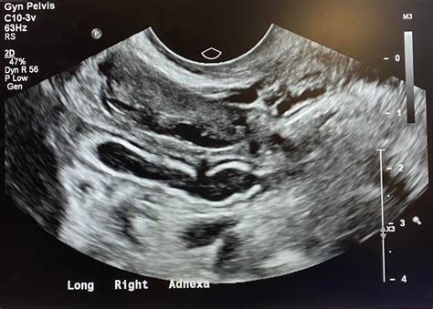 Appendicitis Seen On Transvaginal Ultrasound R Radiology