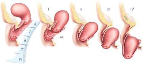 Pelvic Organ Prolapse Pop Nurses Revision