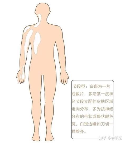节段型白癜风的10大特征，一文读懂 知乎