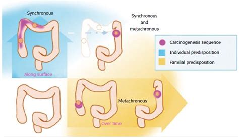 Multiple Primary Colorectal Cancer Individual Or Familial Predisposition Abstract Europe Pmc