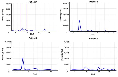 Phenomenology And Physiology Of Tacrolimus Induced Tremor Tremor And