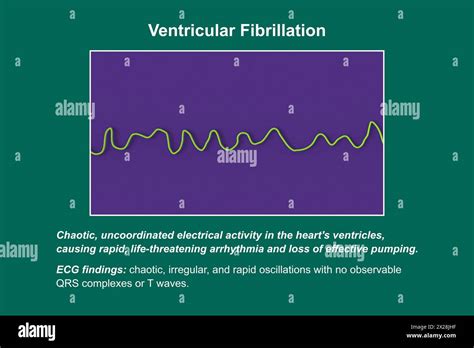 Ventricular Fibrillation Treatment