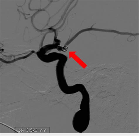 Cerebral Angiography Coil Target With Partial Occlusion Of The Aneurysm Download Scientific