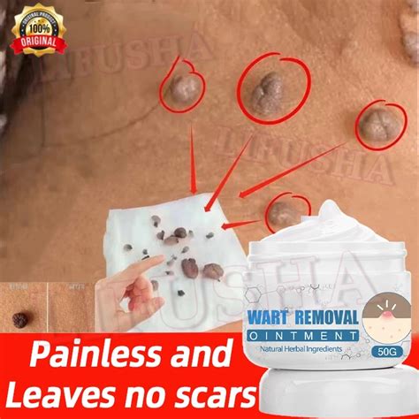 50g Painless Warts Removal Ointment Wart Remover Cream Skin Tags