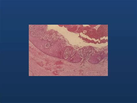 Odontogenic Cysts And Tumors Ppt Ppt