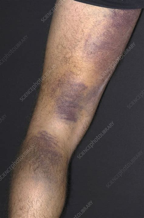 Bruised Leg Stock Image M330 1701 Science Photo Library