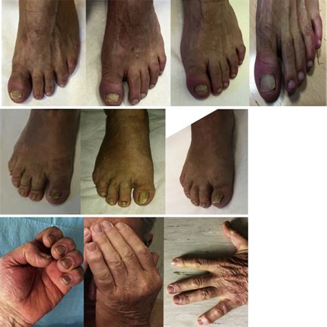 Nail Psoriasis Severity Index Graph W Indicates Week Download