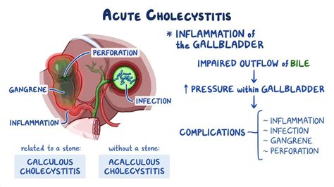 Cholecystitis Video And Meaning Osmosis