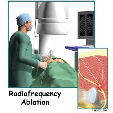 What Is RFA What Is Radiofrequency Ablation Side Effects Of RFA Treatment With RFA Hemonc