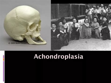 Ppt Achondroplasia Powerpoint Presentation Free Download Id9570522