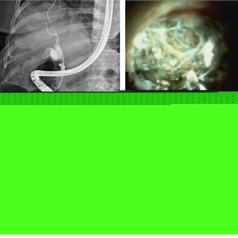 Pdf Efficacy And Safety Of Cholangioscopy Guided Laser Lithotripsy For Difficult Bile Duct