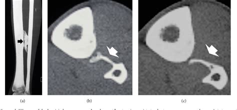 [pdf] Ossification Of The Interosseous Membrane Of The Leg In A Football Player Case Report And