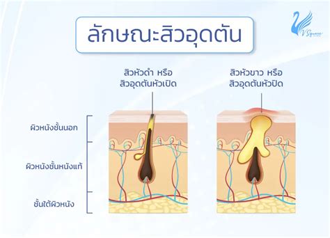 สิว ปัญหาผิวหน้ากวนใจ รักษาสิวอย่างไรดี วิธีกำจัดสิวถาวร ไม่ให้กลับมาอีก