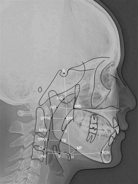 Cephalometric Landmarks And Measurements Of Pharyngeal Airway