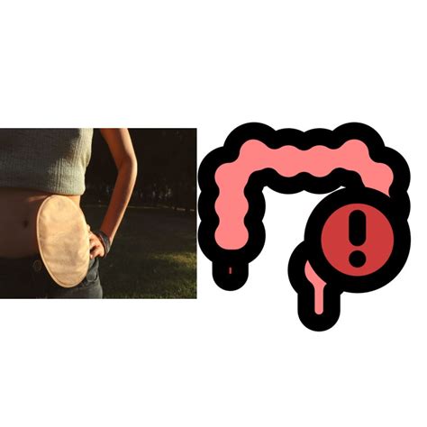 장루 장루주머니 장루 합병증 장루주머니 관리 장루교환 순서 네이버 블로그