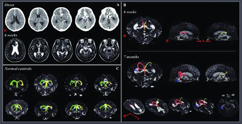A Brain Computerized Tomography In A Female Stroke Patient On The Day