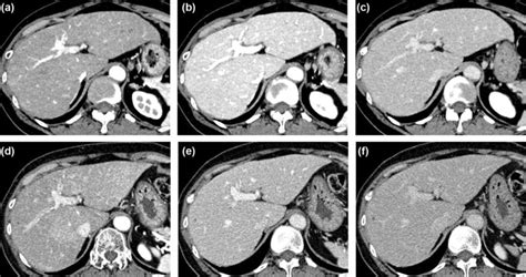 Comparison Of CT Images Between Low Tube Voltage 70 KVp And Download Scientific Diagram