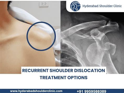 Recurrent Shoulder Dislocation Treatment Options In Hyderabad Shoulder Clinic Hyderabad