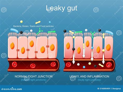 Leaky Gut Close Up Of Cells Of A Intestinal Epithelium Stock Vector