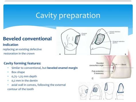Class Iii Iv V Cavity Preparations For Composites Selvi