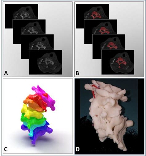 3d Model Reconstruction Of The Pre Operative Cervical Spine Dicom
