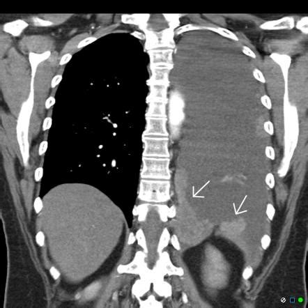 Ipsilateral Pleural Metastases Breast Cancer Radiology Case
