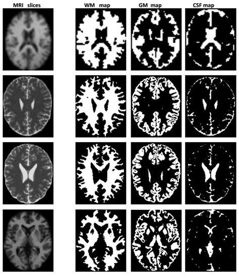 Fuzzy Maps Of Wm Gm And Csf Tissues Calculated With Pfcm Modeling
